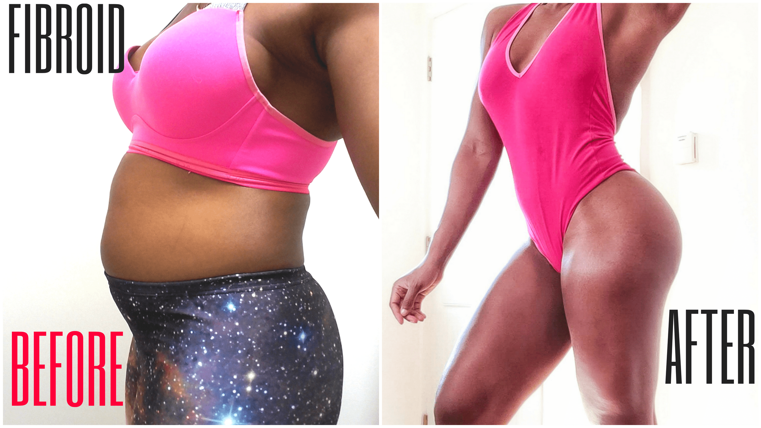 My Fibroid Story From Start To Almost Finish Laparoscopic Myomectomy My Fibroid Story From Start To Almost Finish Laparoscopic Myomectomy